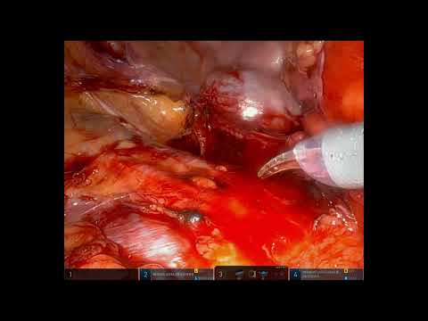 Oophorectomy with severe adhesions