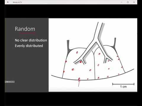 Micronodular Lung Disease Part 1