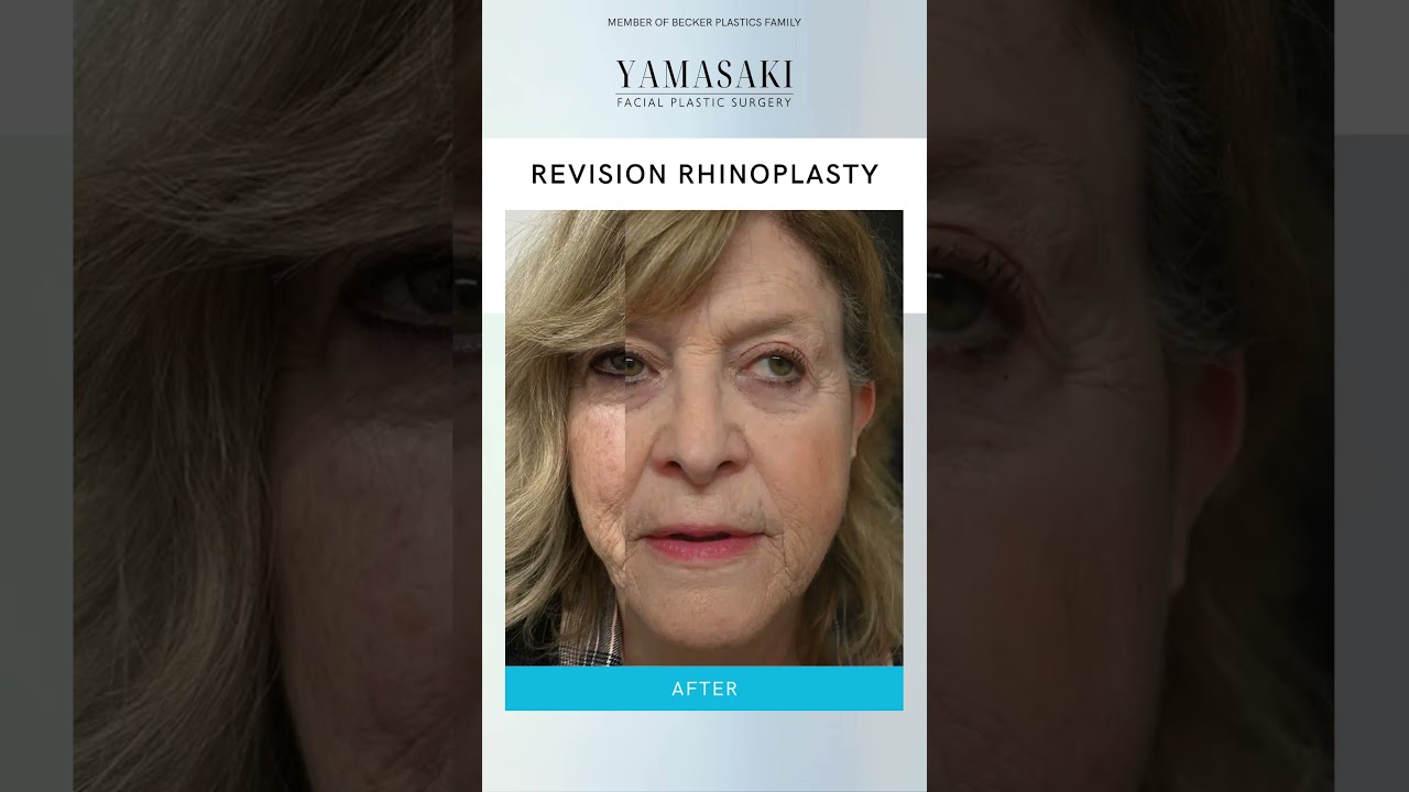 Revision Rhinoplasty, Done with Precision 👃✨ | Dr. Yamasaki