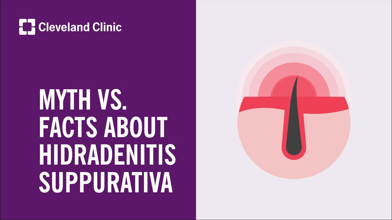 Myth vs. Facts about Hidradenitis Suppurativa