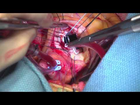 Aortic Valve Replacement Step by Step (Step 3 of 7)