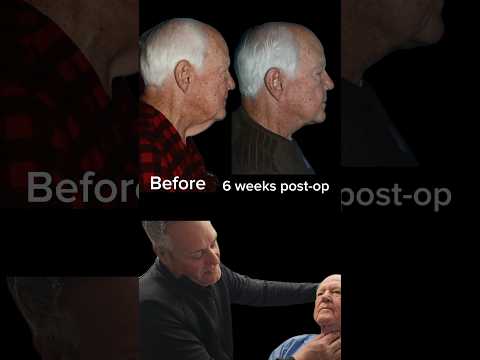 Direct Neck Lift - What’s that?