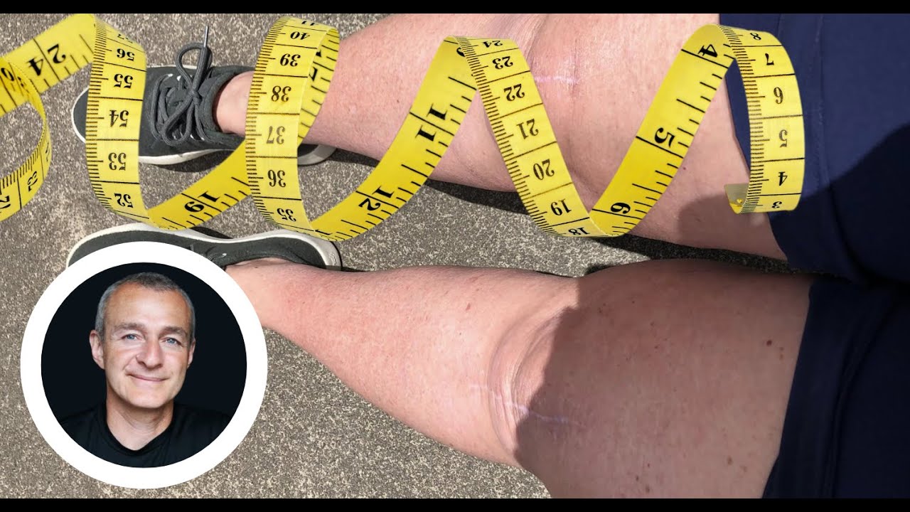 Did Knee Replacement Cause a Longer Leg?