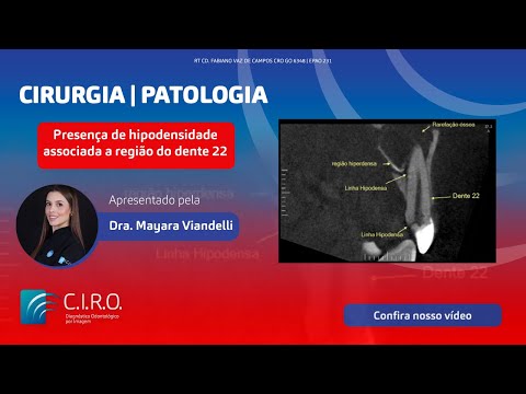 Presença de hipodensidade associada a região do dente 22 | Caso clínico com a Dra. Mayara Viandelli