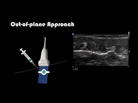Introduction to US Guided Nerve Blocks Part I