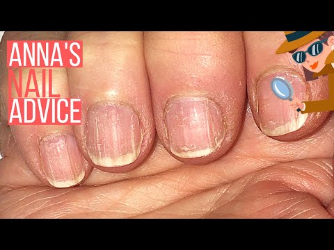 How To Care For Ridgy Nails  [ANNA'S NAIL ADVICE] 🕵️‍♀️
