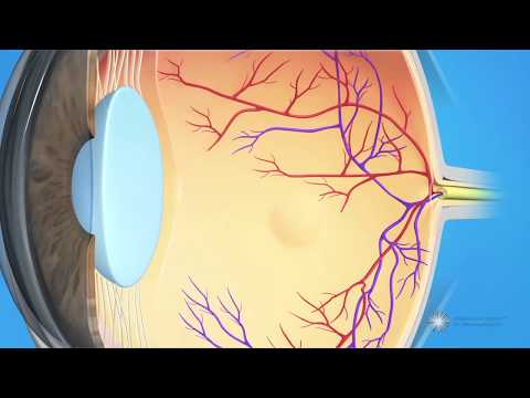 What is dry age-related macular degeneration (AMD)?