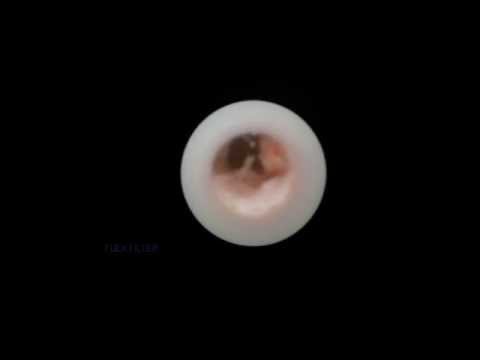 SVZbiopsy subventricular zone progenitors frontal horn