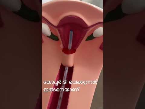 ഇതാണ് ഏറ്റവും നല്ല ഗർഭനിരോധന മാർഗം-കോപ്പർ ടി 😱Copper T Malayalam Pregnancy #shorts#subscribe#viral
