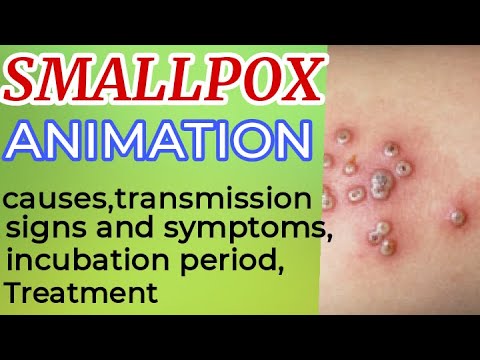 Smallpox symptoms | smallpox treatment | small pox | smallpox animation | smallpox virus | 3D