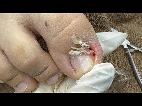 Ingrown Toenail Cure: Toenails in the flesh#satisfying#nails