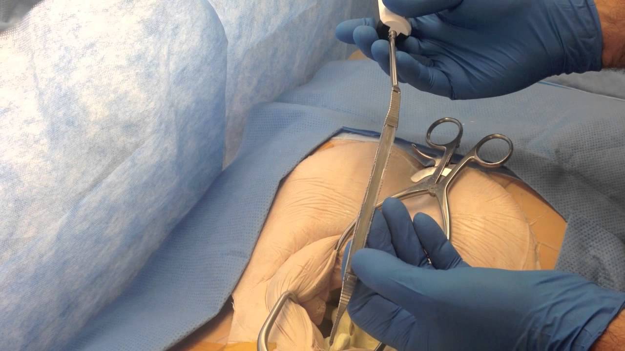 iO-Tome: A Rapid Facetectomy Device