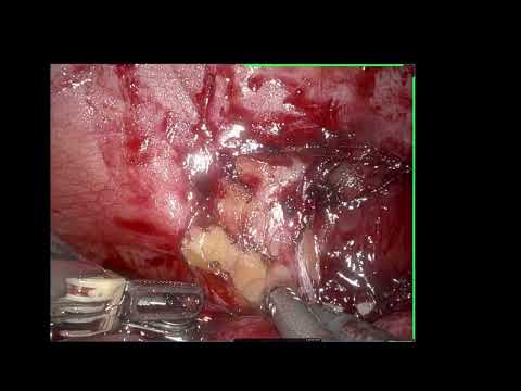 Robotic Psoas Hitch and Left Ureteral Reimplant