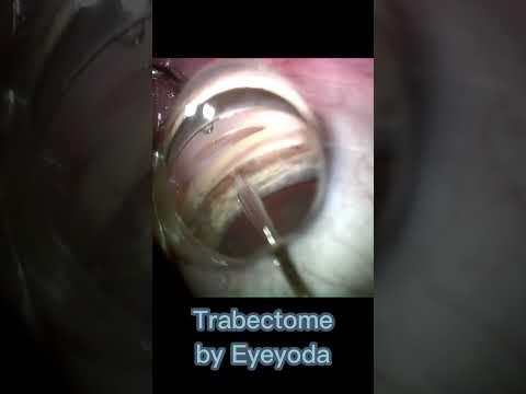 Trabectome! #glaucoma #glaucomasurgery #ophthalmology #eyes #ophthalmologists #eyesurgery