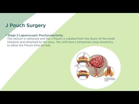 J Pouch Surgery