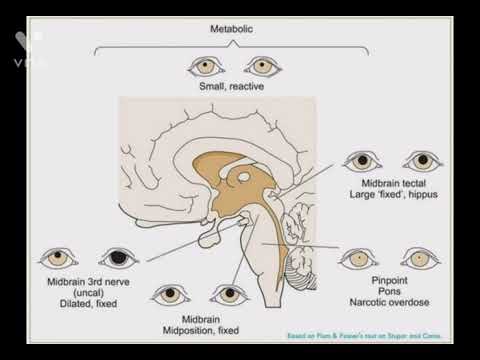 #Approach to Stupor & Coma...