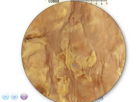 Aorta: Atherosclerosis