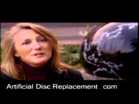 Sue a 3 level disc replacement success by Dr. Ritter-Lang