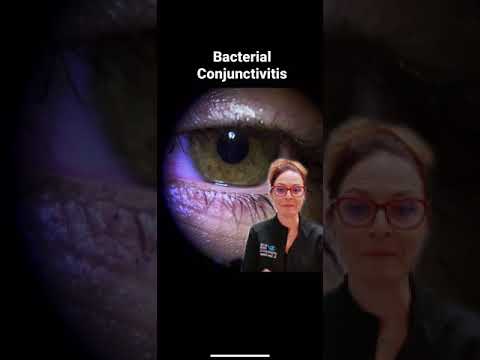 Bacterial Conjunctivitis is a form of “pink eye” caused by a bacterial infection.