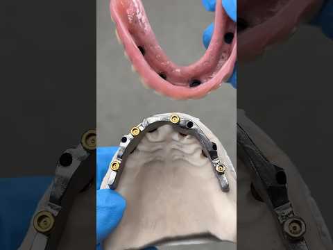 Locator #Denture with a Hybrid Bar #dental #teeth #smile #lsk121shorts #shortvideo #shorts