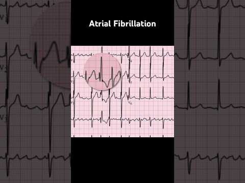 Atrial Fibrillation ECG: Ashman phenomenon