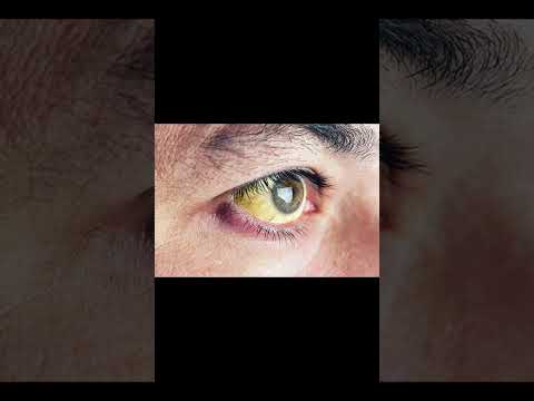 What Your Eyes Say About Your Health - Yellow Whites of Your Eyes