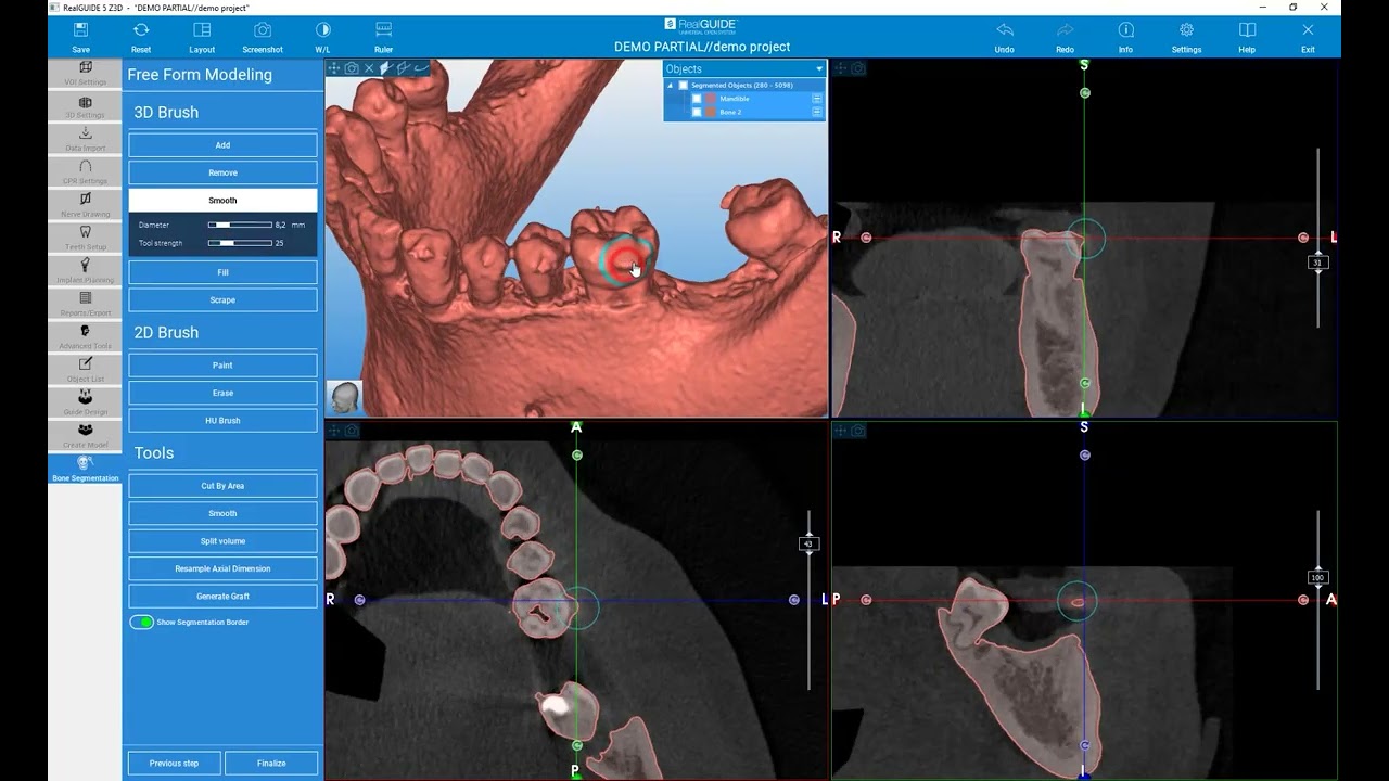RealGUIDE Software:  Bone Segmentation