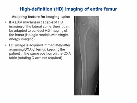 Atypical Femur Fractures: Addressing the Problem from a Patient-Centered Perspective