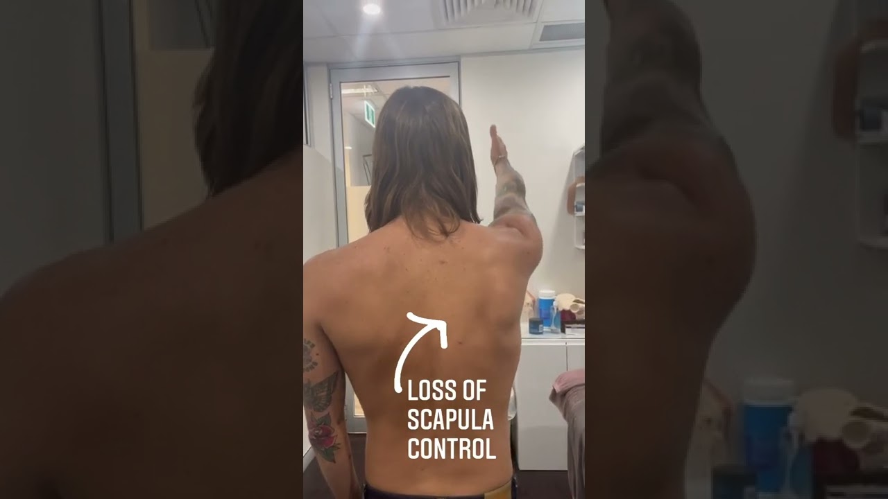 Here is some pretty extreme evidence of loss of scapula control and scapula winging!