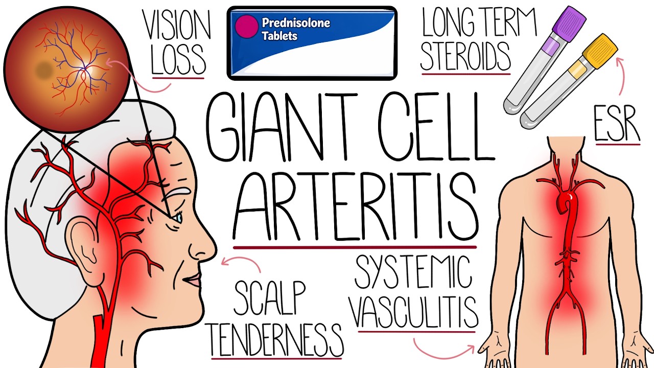 Giant Cell Arteritis Explained Clearly