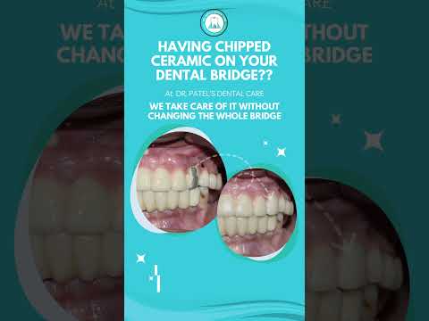 From Damaged to Dazzling! Before and After picture showing repair of chipped Ceramic on dental crown