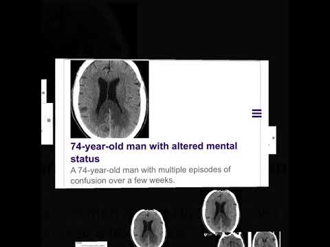 Gliomatosis cerebri