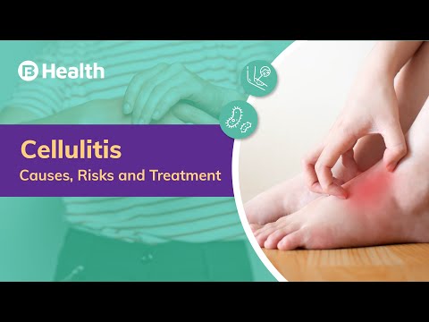 What is Cellulitis? | Causes, Symptoms, Diagnosis, and Treatment | Bajaj Finserv Health