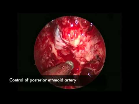 Olfactory cleft meningioma