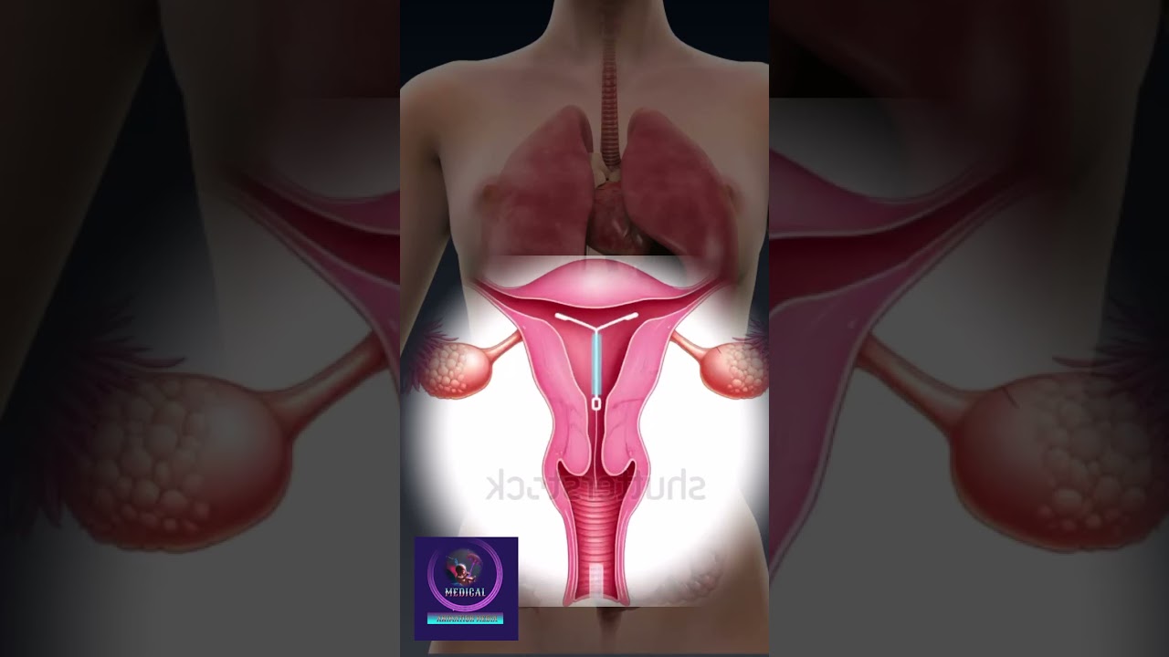 IUD Insertion - Birth Control Method