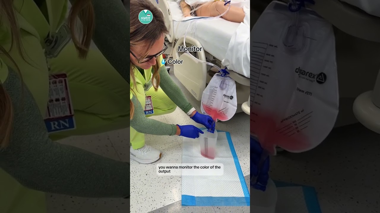 Continuous Bladder Irrigation (CBI) 💦