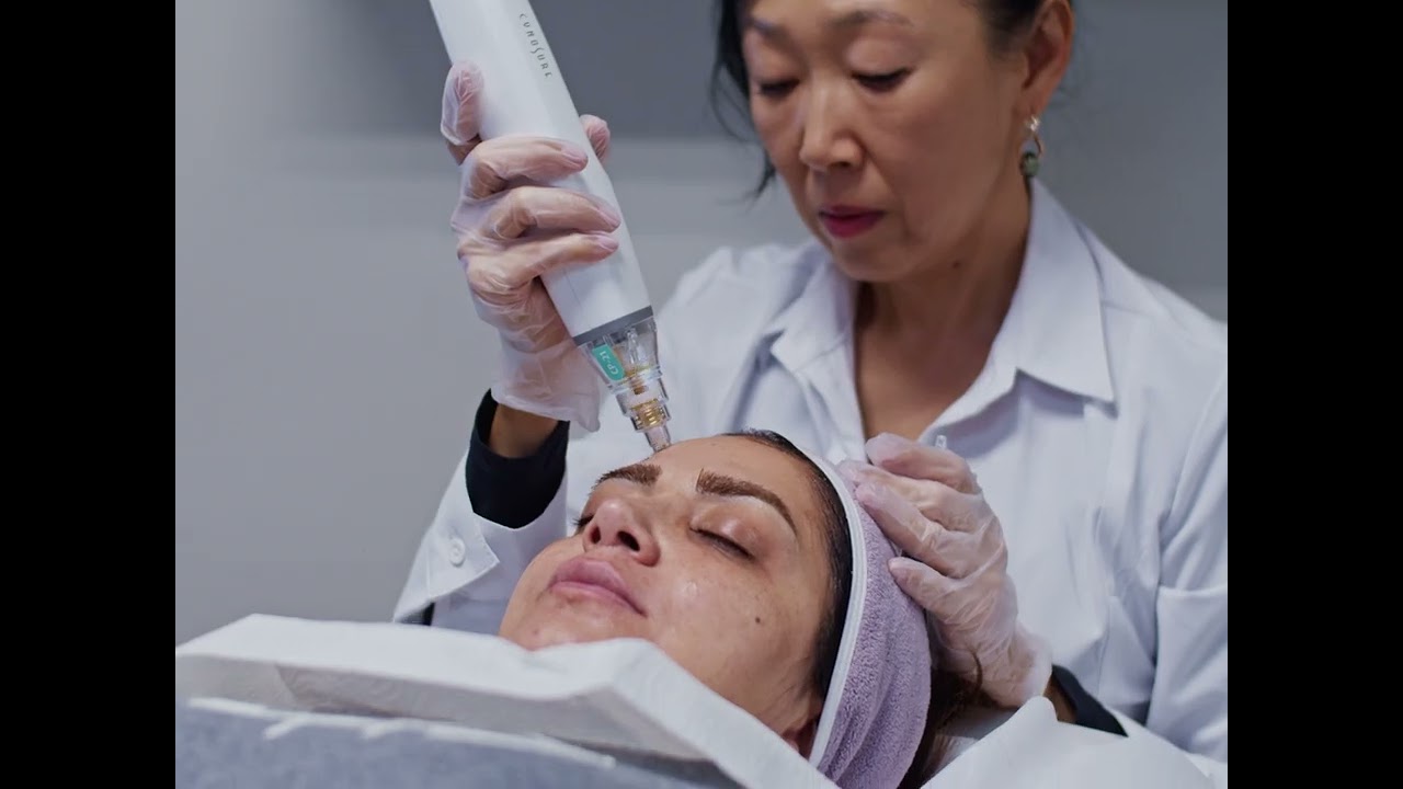 Potenza RF Microneedling   LASERSKIN CA
