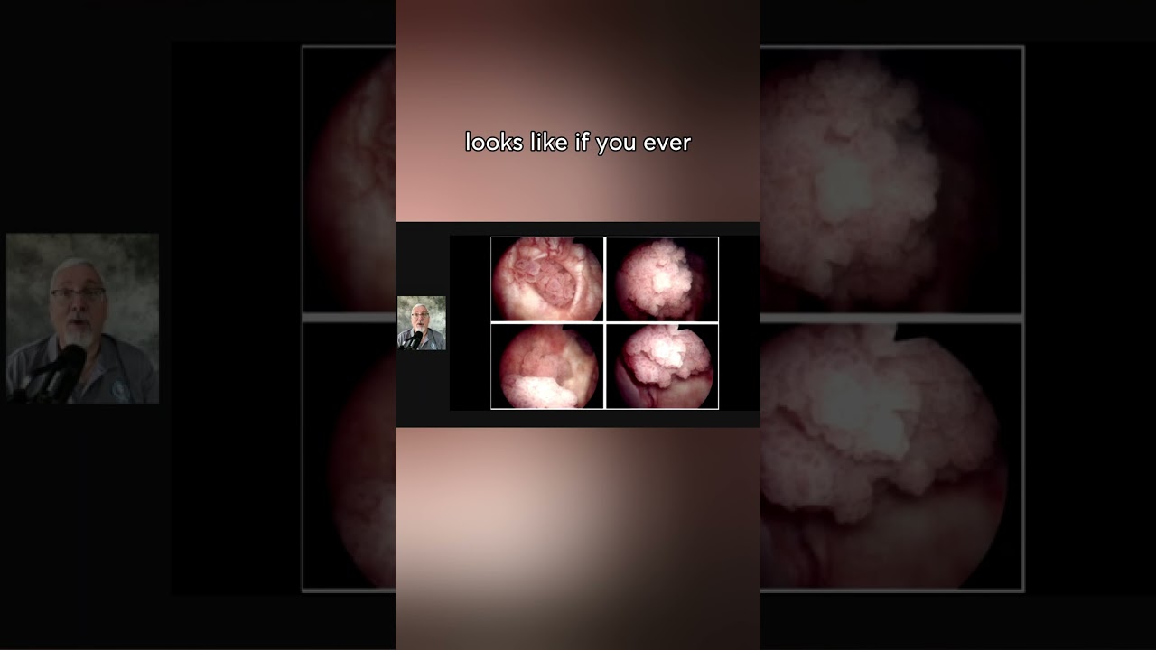 What do Bladder tumors look like