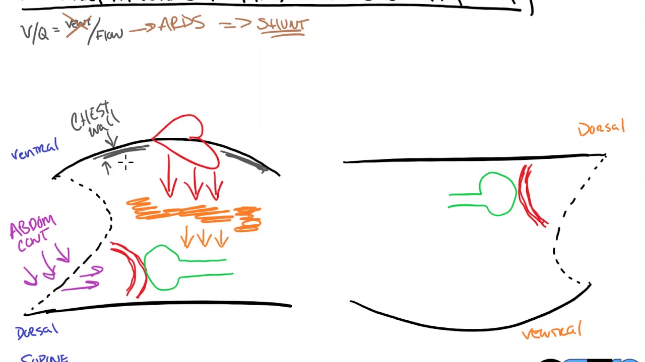 Understanding the Physiology of Proning in ARDS | Galaxy.ai