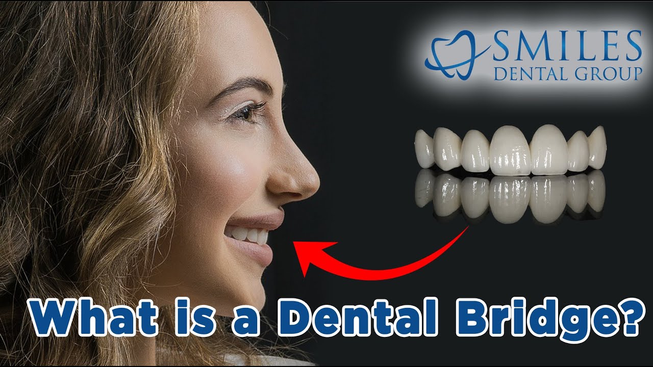 What is a Dental Bridge? How is it Made (2025)?