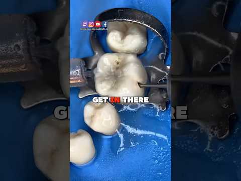 “This is it baby”😂 We love how passionate Dr Paisner gets with his fillings🙌🏼🔥#funny #dentist