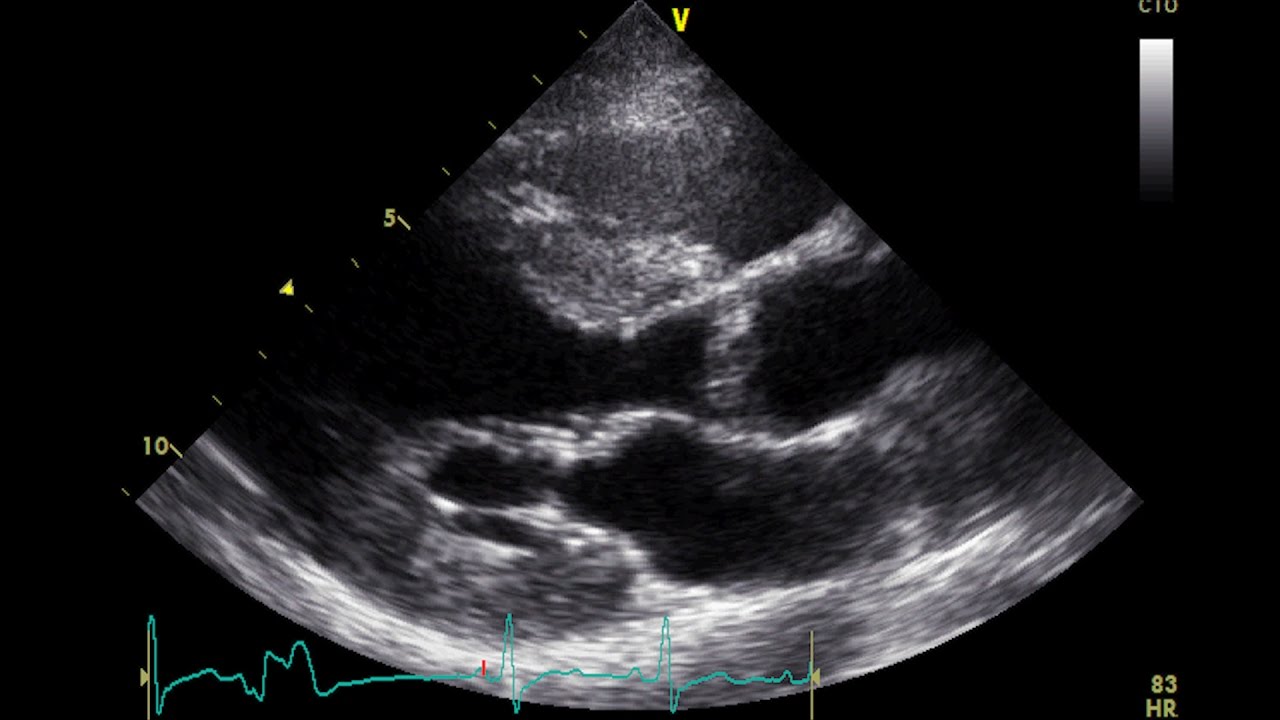 PVC Echo Parasternal Long Axis View - Aortic Stenosis