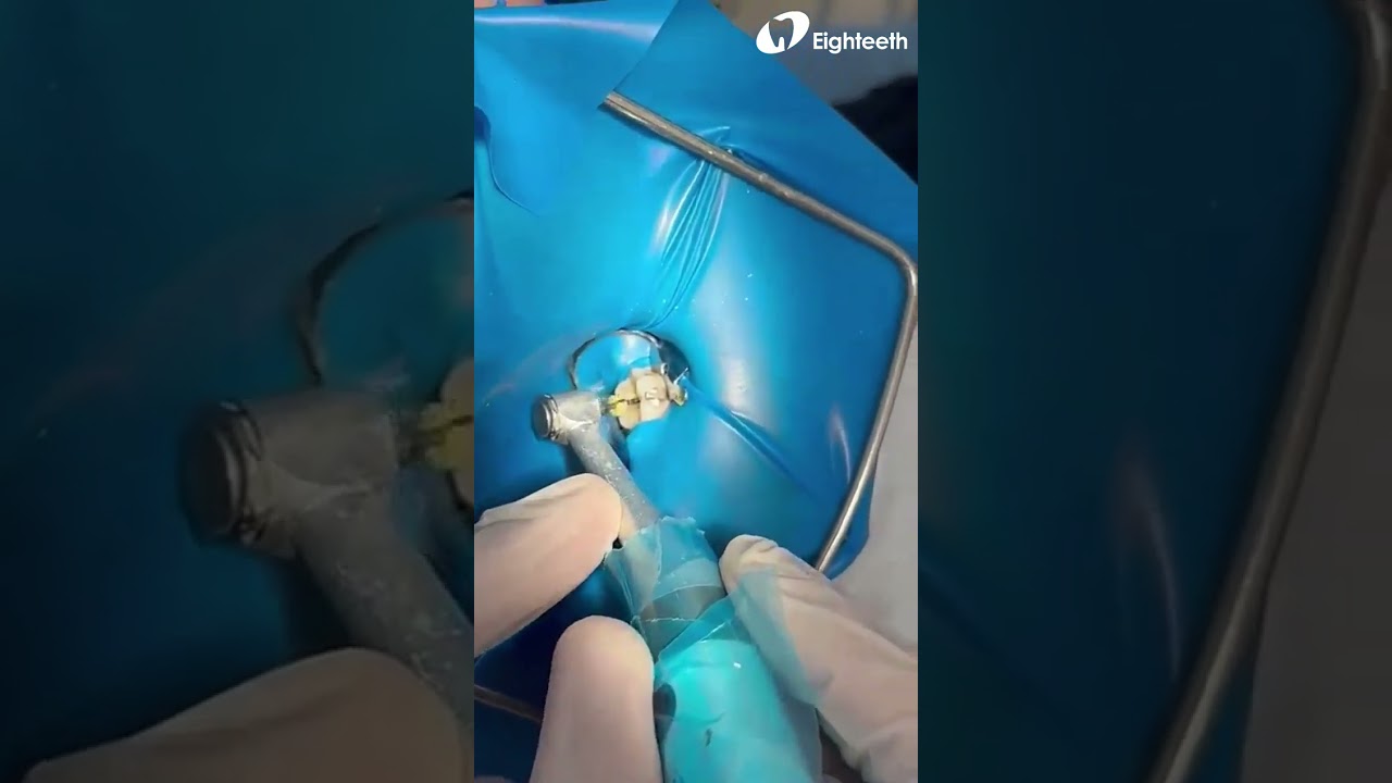 Root Canal Preparation Using Eighteeth E-FLEX BLUE Endo Files- Dr. Moh'd Hammo