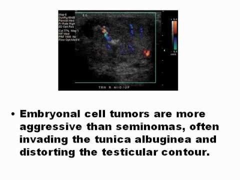 SCROTUM ULTRASOUND PART 6.wmv