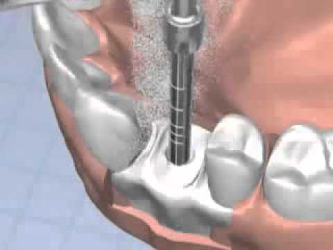 YouTube Zahnimplantation Surgery of Dental Implant Animation