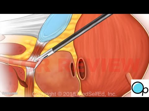 PreOp® Robotic Assisted Laparoscopic Radical Prostatectomy