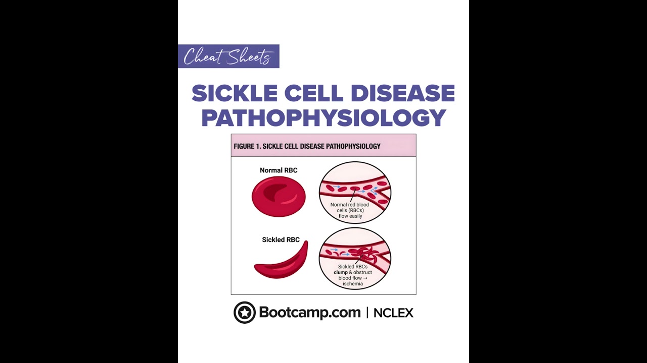 🔬 Sickle Cell Disease Pathophysiology – NCLEX Must-Know! | NCLEX Bootcamp Cheat Sheet