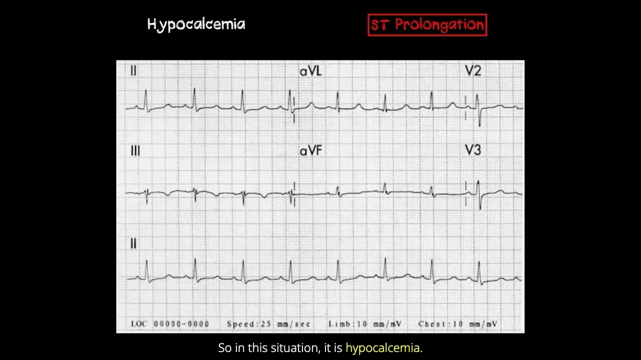 Recognizing Hypocalcemia: ECG Changes & Key Indicators