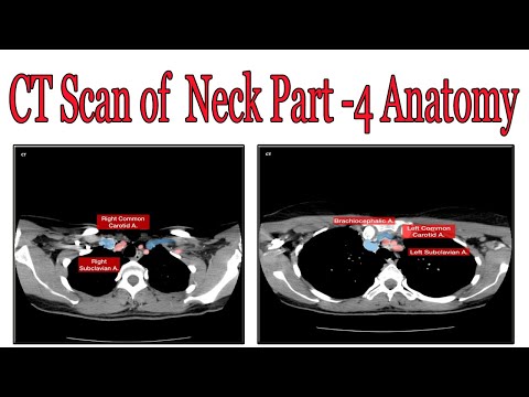 CT scan of neck axial part 4 anatomy