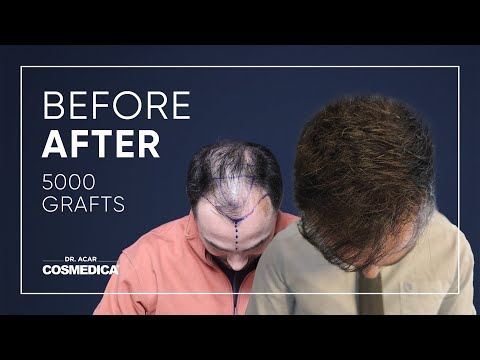 Hair Transplant in Turkey | Results | Dr. Acar | Cosmedica Clinic